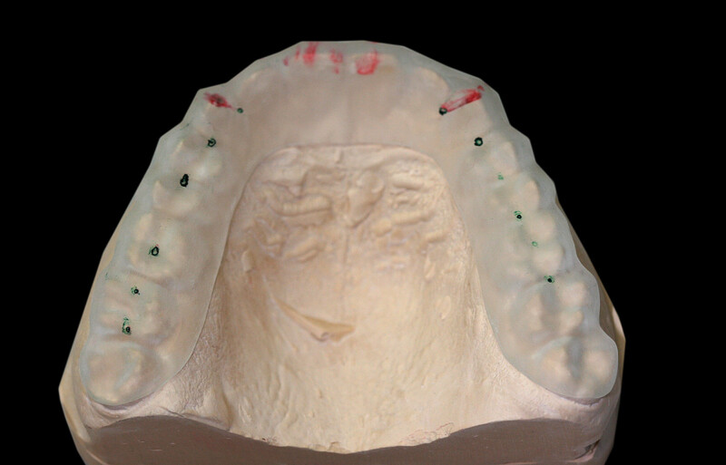 Aufbissschiene – Aber richtig! | Dental Team Dr. Hajtó München