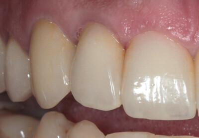 Tiefe Zahnfleischentzündung | Dental Team Dr. Hajtó München