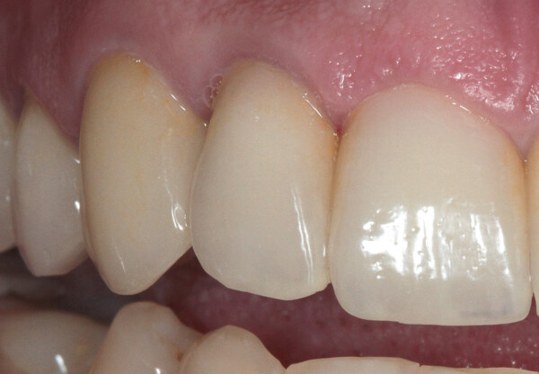 Tiefe Zahnfleischentzündung | Dental Team Dr. Hajtó München