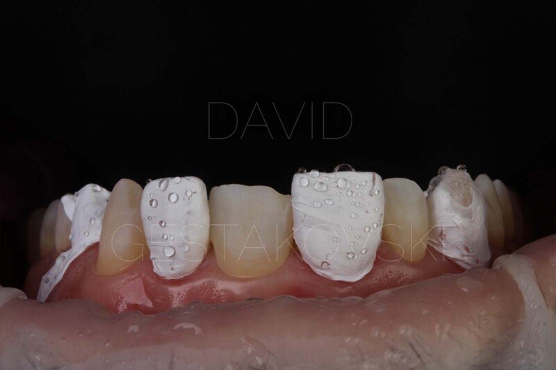 Flowable Injection Anteriors Hands-On Course by David Geštakovski